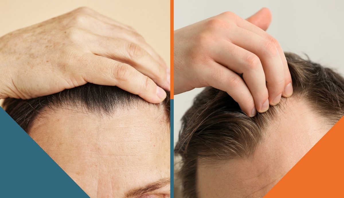 Widow’s Peak vs. Receding Hairline: The Battle No One Asked For ...